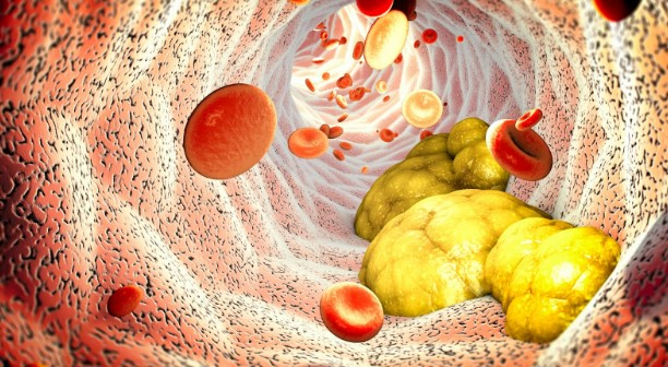 What Is LDL Apheresis?